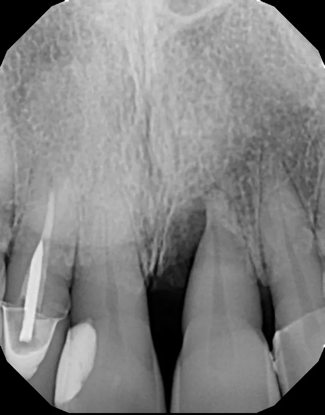 Guided Bone Regeneration Portland ME | Guided Tissue Regeneration